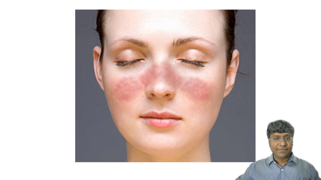 Malar Rash - YouTube