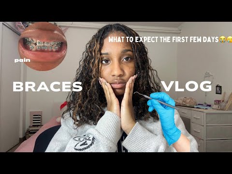 I GOT BRACES !! | my experience + what to expect | *very painful * 