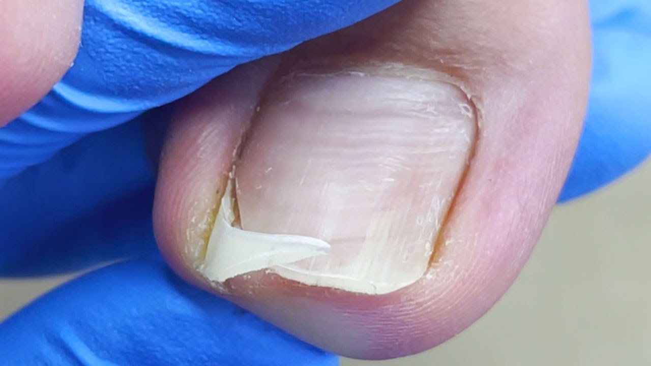 Nail inlay treatment stage, the process of trimming excess long nails ...