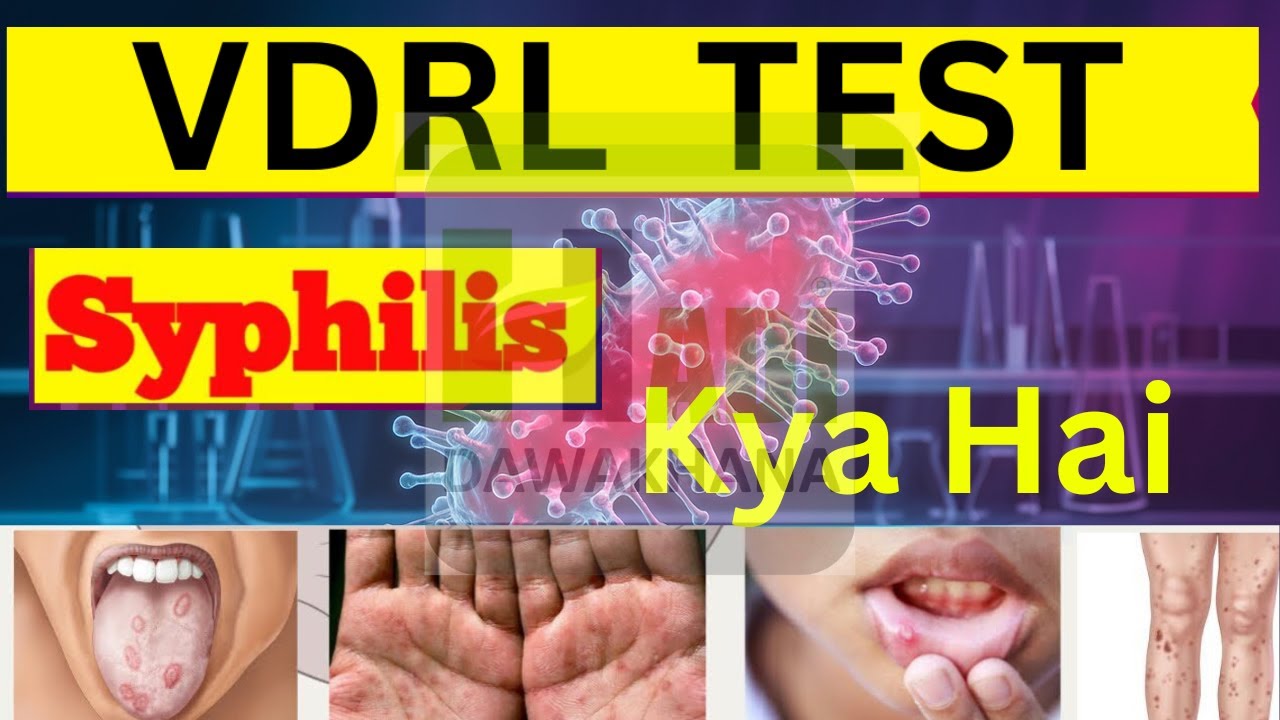 VDRL Positive Test Kya Hota hai | Vdrl Positive Causes Symptoms ...