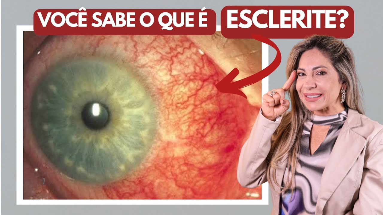 Esclerite: Tudo Que Você Precisa Saber Sobre! - YouTube