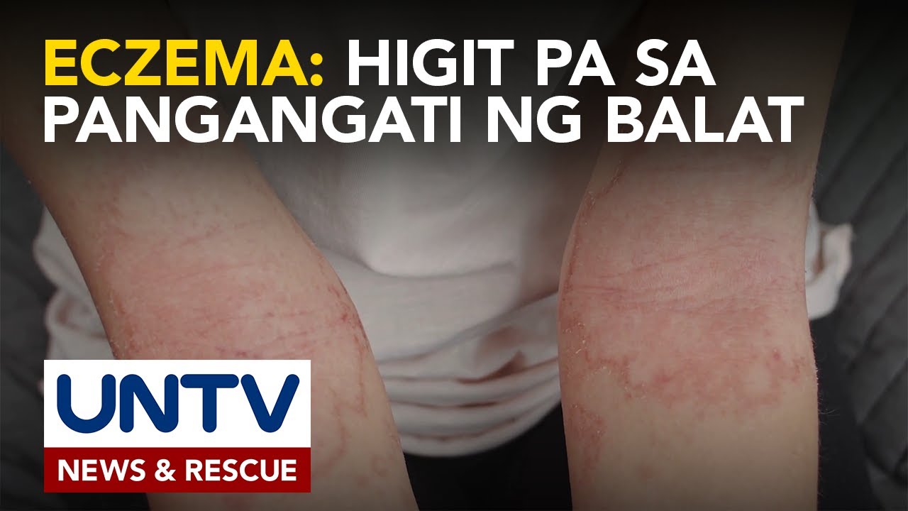 Eczema, hindi lang karaniwang pangangati ng balat – dermatologist - YouTube