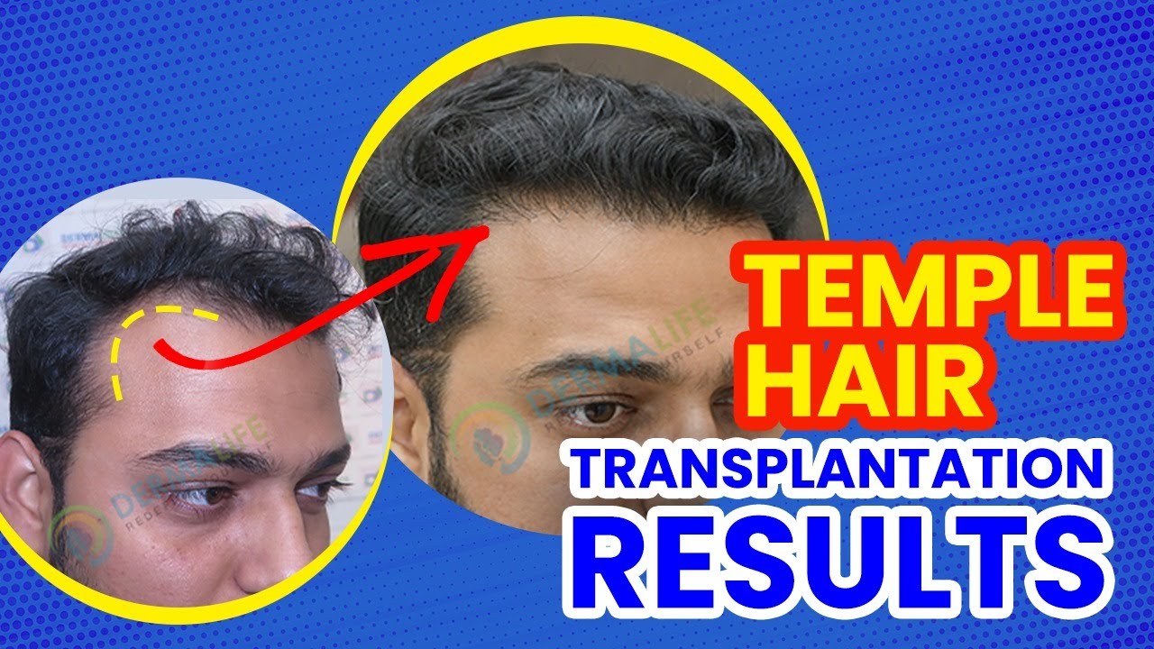 Temple Hair Transplantation Results | Temple Point in Hair Transplant💥 ...