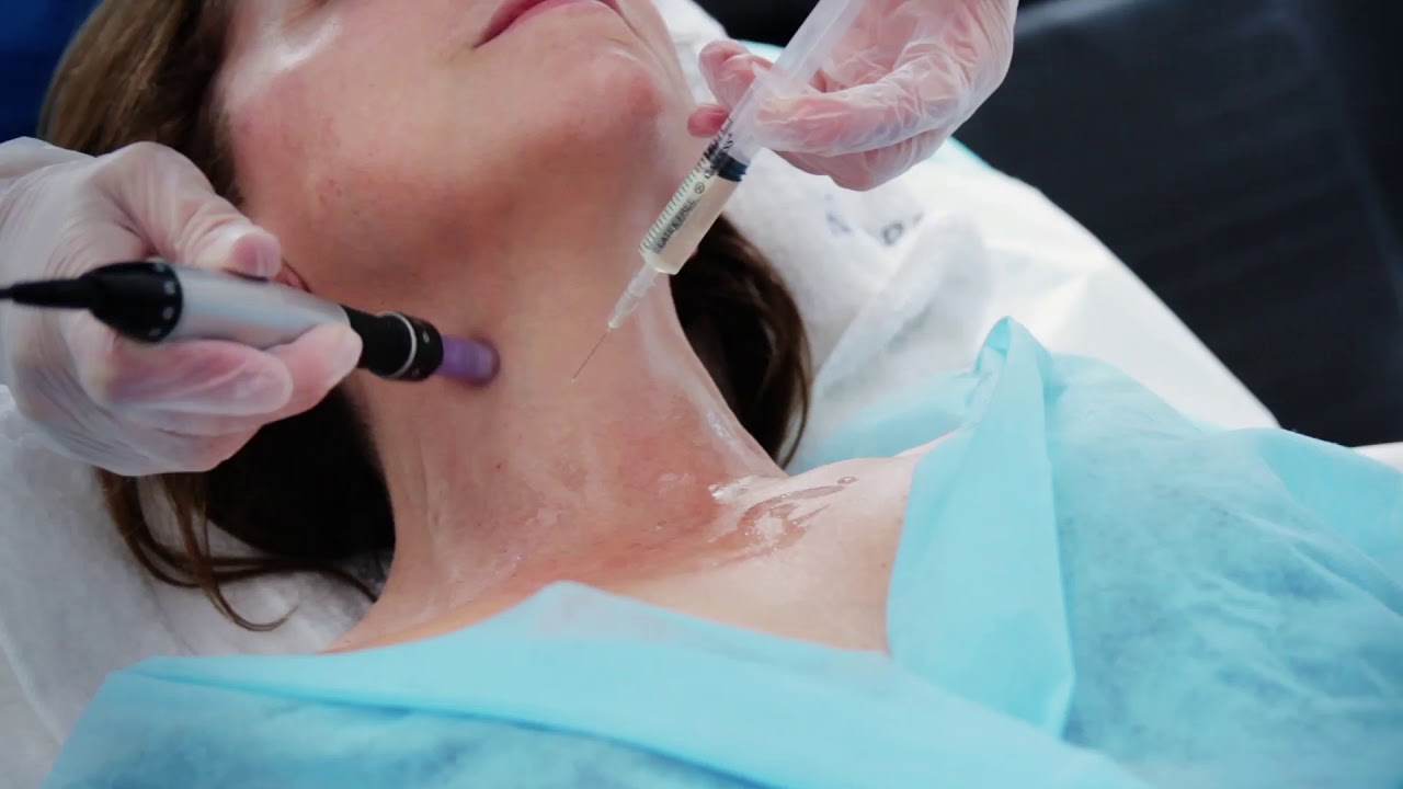 Mesolift en Clínica Dray - YouTube