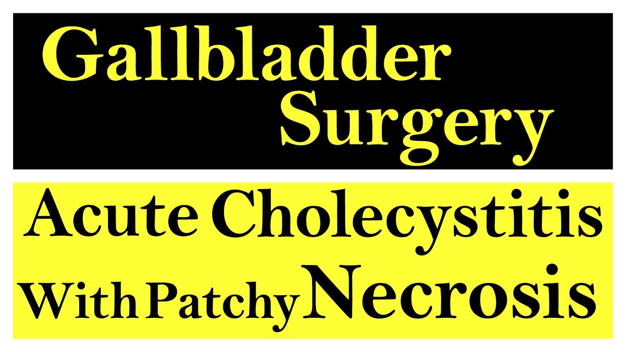 Gallbladder Surgery- Acute Cholecystitis With Patchy Necrosis | Dr ...