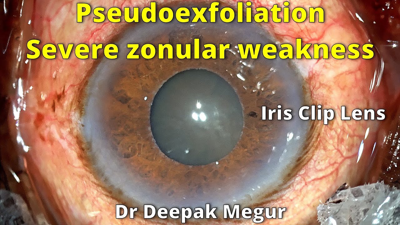 Iris Claw lens in an eye with Pseudoexfoliation and severe zonular ...