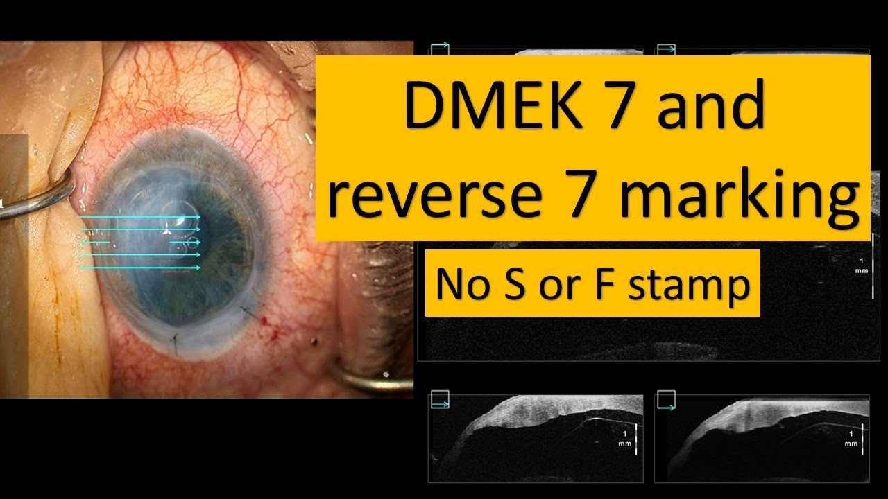 DMEK orientation with 7 or reverse 7 marking - YouTube