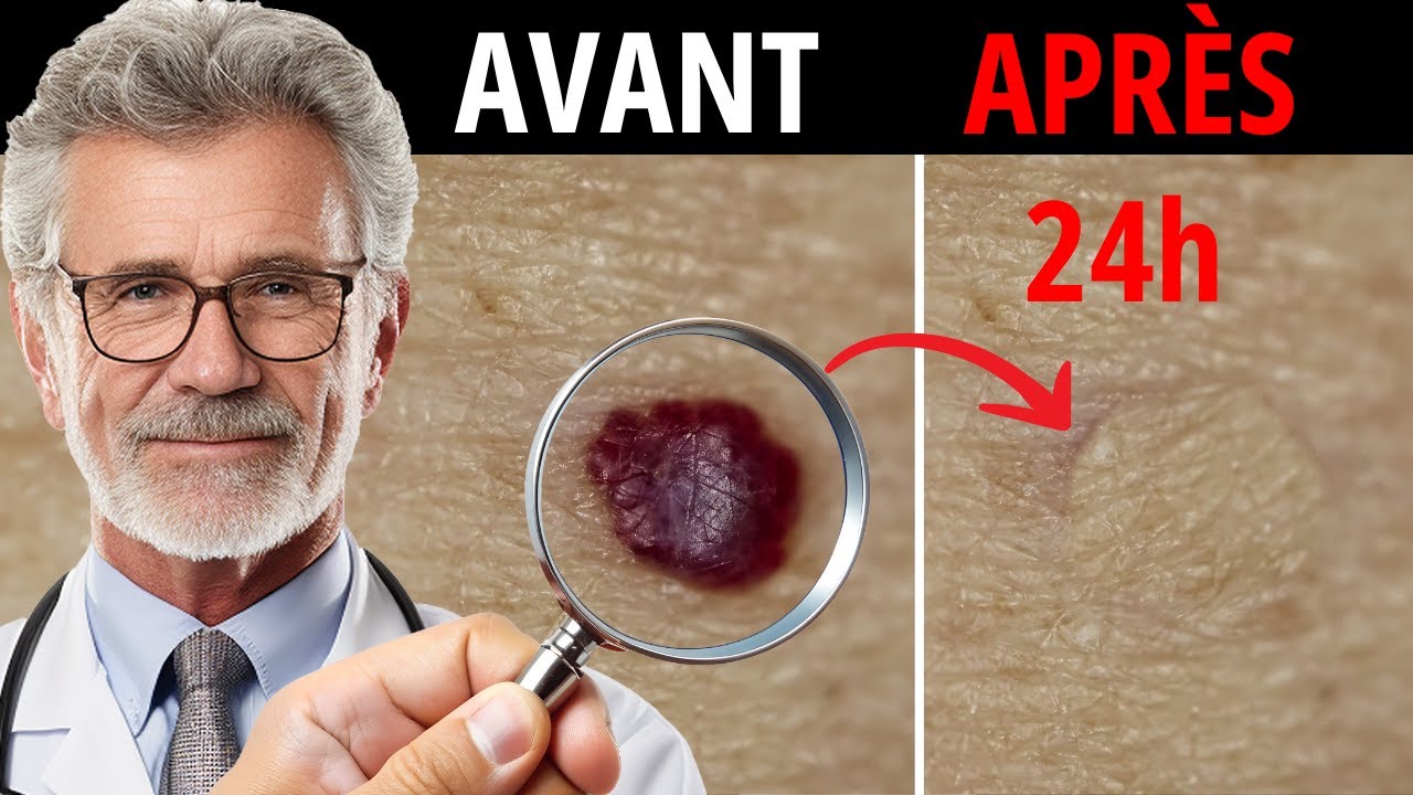 Comment ÉLIMINER les PAPILLOMES de la peau et les VERRUES en une nuit ...