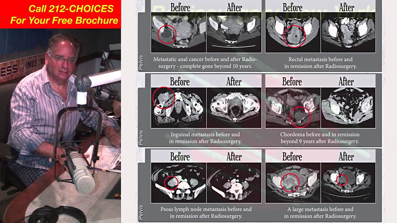 Dr. Gil Lederman's Radiosurgery Show! Podcast 127 Part FOUR - YouTube