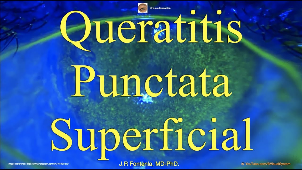 Queratitis Punctata Superficial. - YouTube