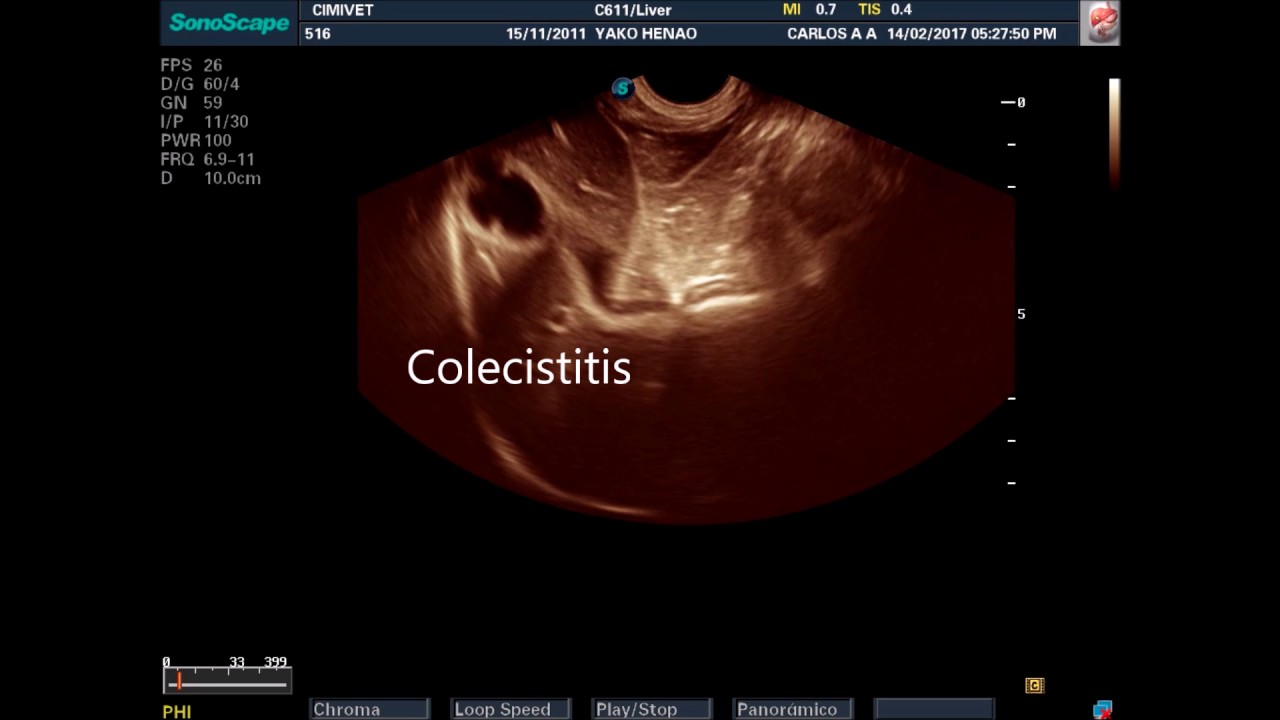 absceso prostatico, nodulo en bazo, colecistitis y cálculo vesical ...