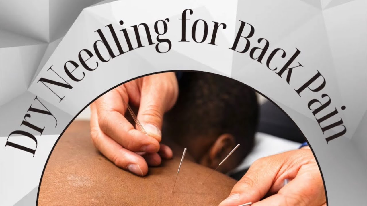 Dry Needling for Low Back Pain - YouTube