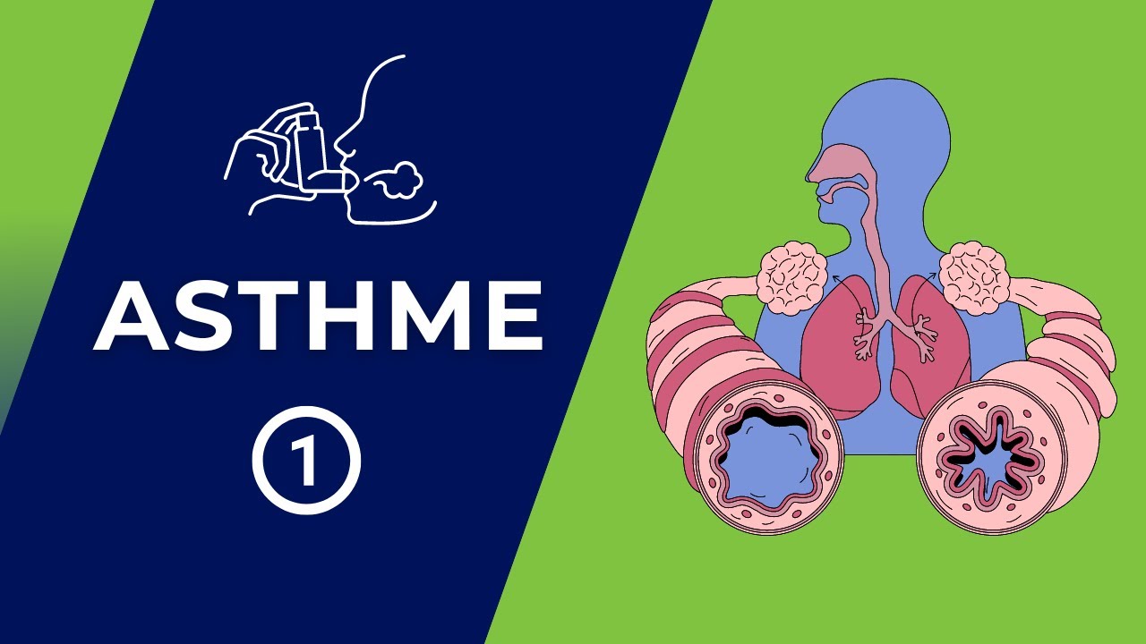 Asthme Aigu et Stable : Définition, Physiopathologie, Diagnostique ...