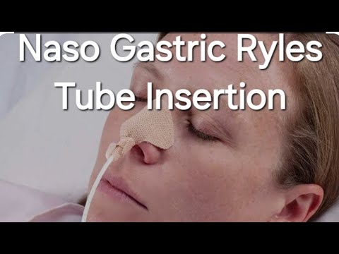 NASOGASTRIC RYLES TUBE INSERTION - YouTube