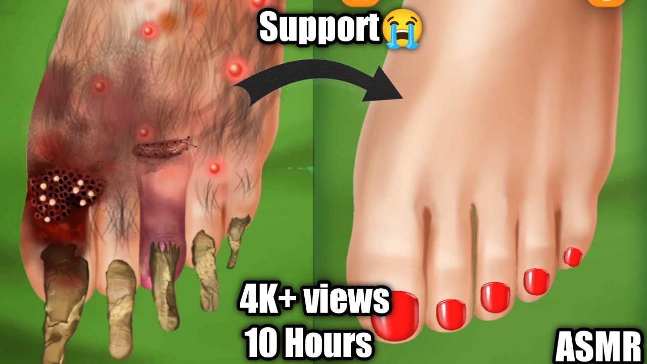 ASMR Foot Treatment Animation | Plzz 4K Hours Watch Time Compete😭#asmr ...