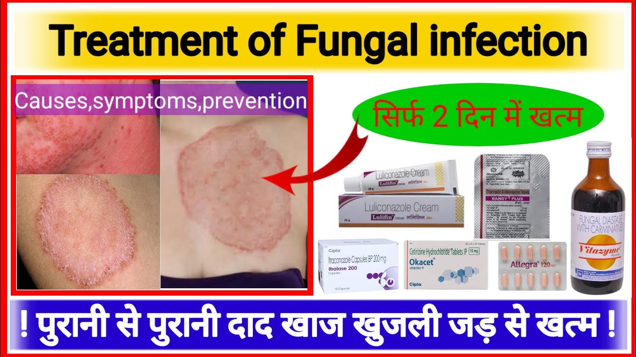 Fungal infection treatment/ दाद खाज खुजली की दवाइयां और इलाज/ खुजली को ...