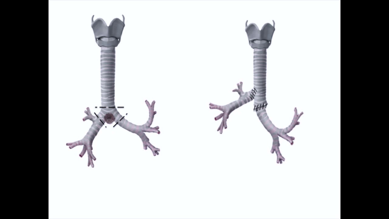 Asvide: Carinal resection is performed with an end-to-end anastomosis ...