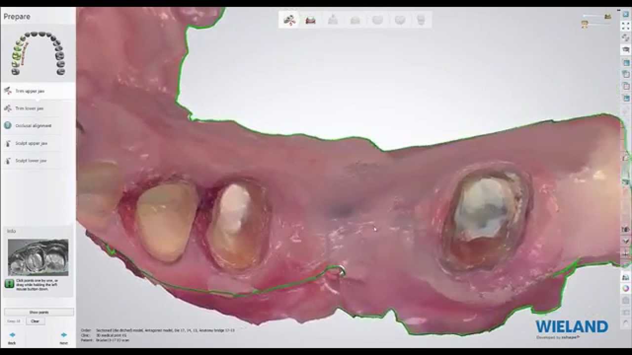 designing a full anatomical bridge in 3shape - YouTube