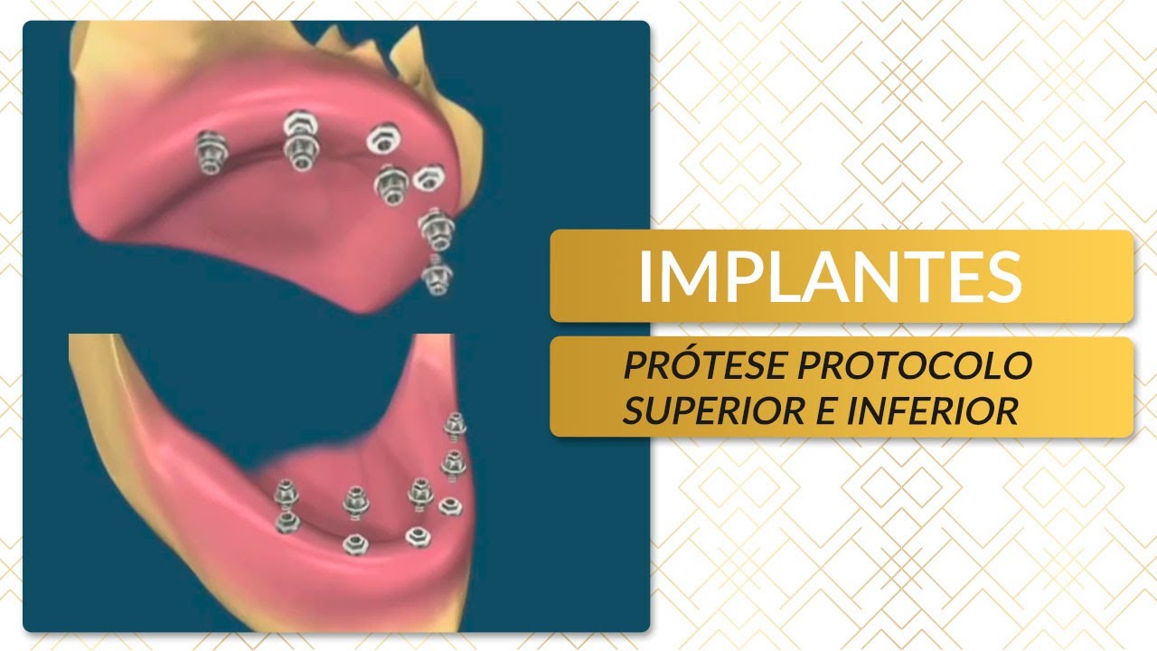 Prótese Protocolo superior e inferior - YouTube