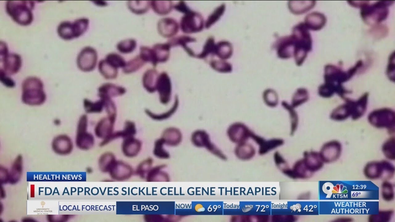 Two gene therapies for sickle cell disease approved in US - YouTube