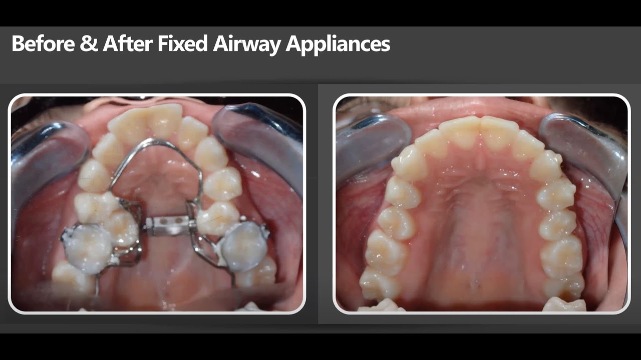 Airway Chat #1 with Dr Ben Miraglia: Airway Expansion Appliances ...