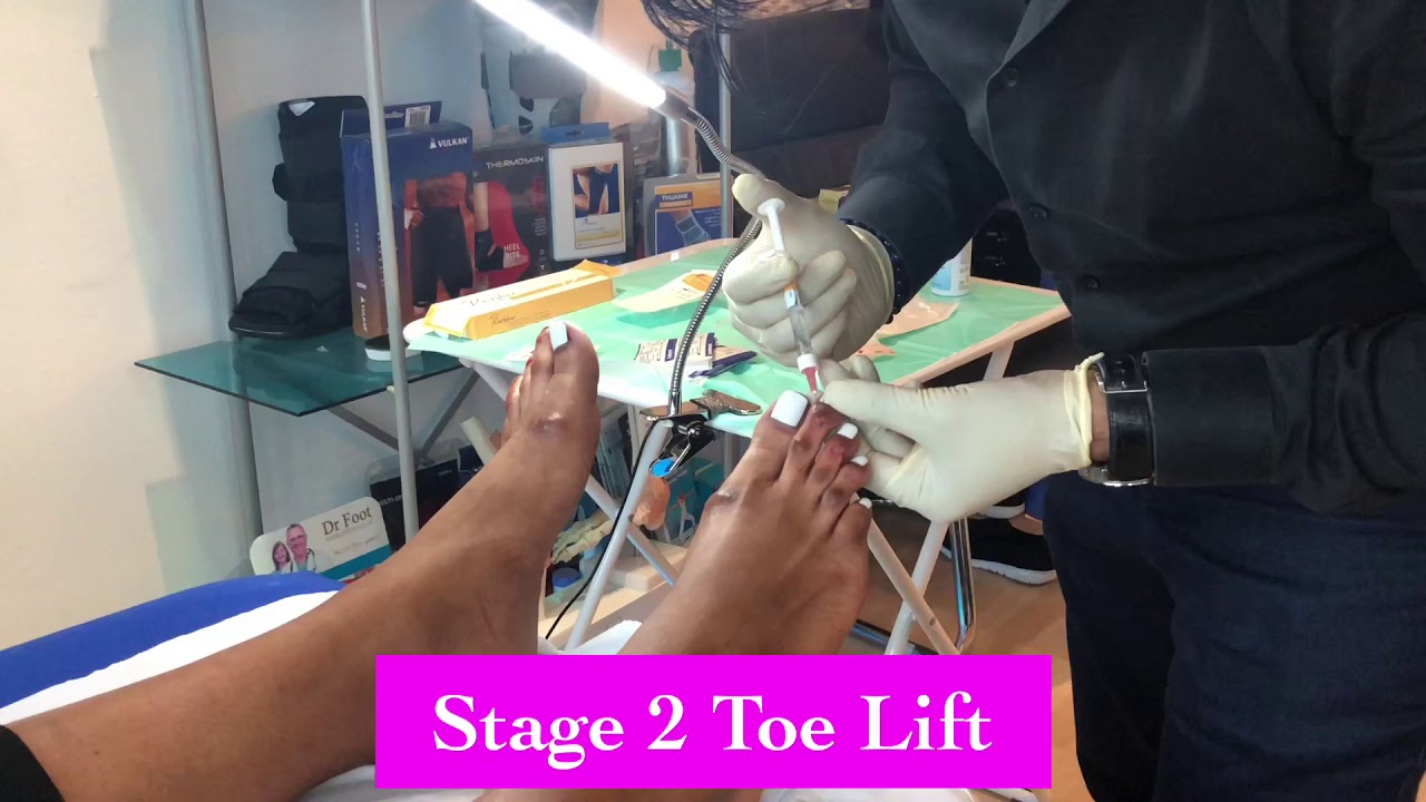 Stage 2 of the Toe Lift - YouTube