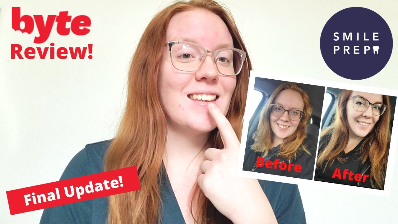 Final Results! - Before & After Byte for High Canine Tooth ...