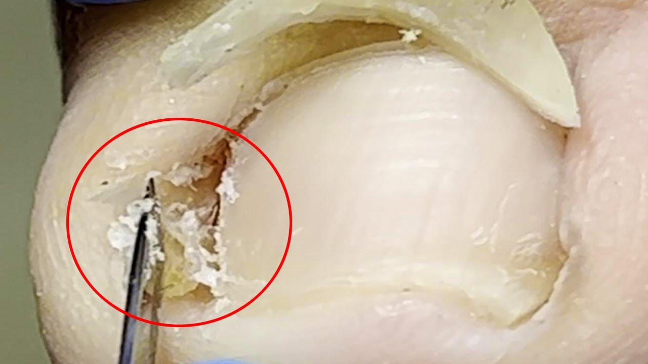 Inflamed toenails, trim excess ingrown nails【Xue Yidao Pedicure】 - YouTube