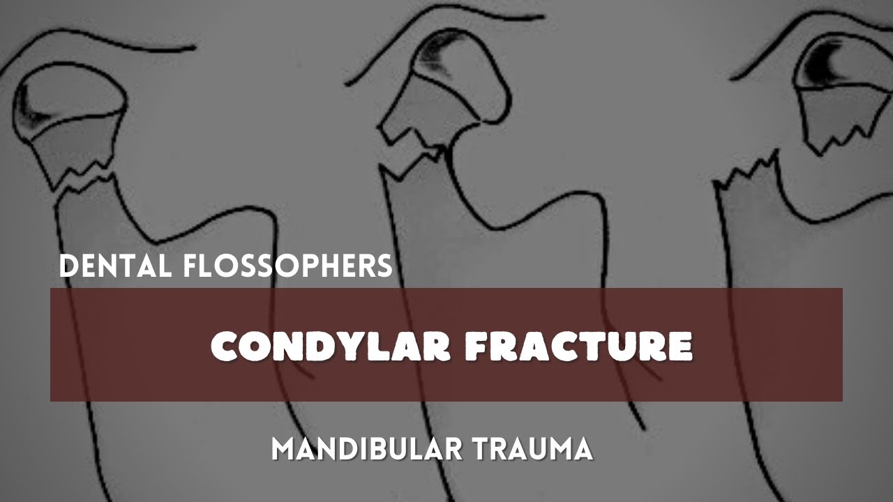 CONDYLAR FRACTURES || MANDIBULAR FRACTURE || SUBCONDYLARFRACTURE ...