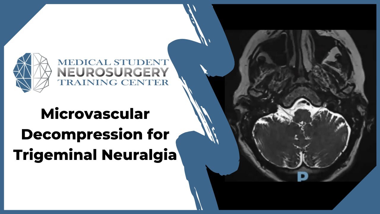 Microvascular Decompression for Trigeminal Neuralgia - YouTube