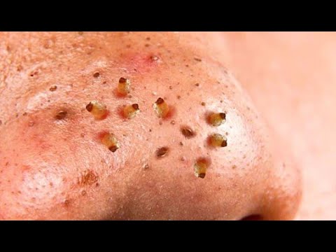 Satisfying Pimple popping and Blackhead Removal compilation (Very ...