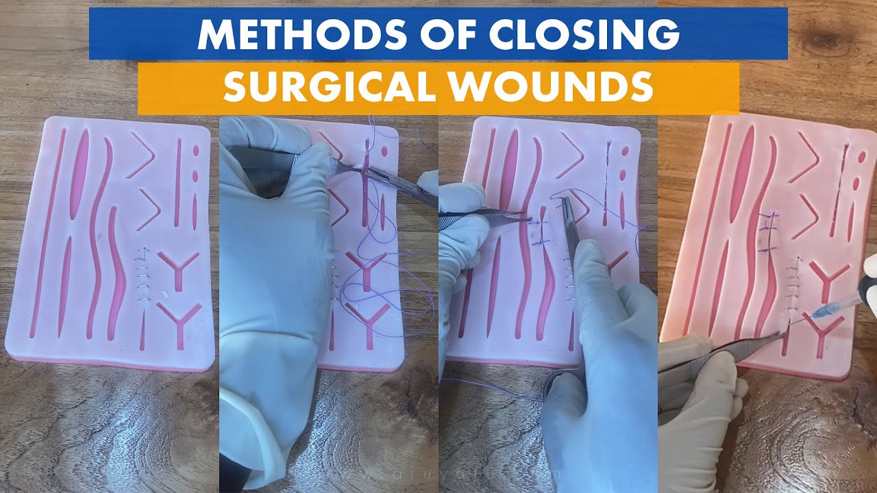 See how surgeons can use a stapler on your skin - YouTube