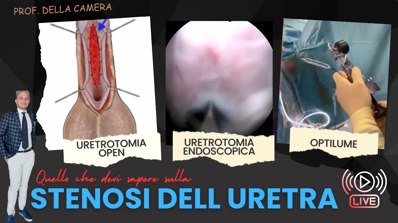 Stenosi dell Uretra e recidive: cosa fare ? - YouTube
