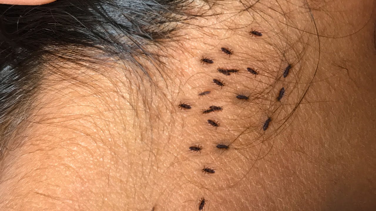 Nits picking Lice Picking Using Comb Lice Picking Long Hair ##15 - YouTube