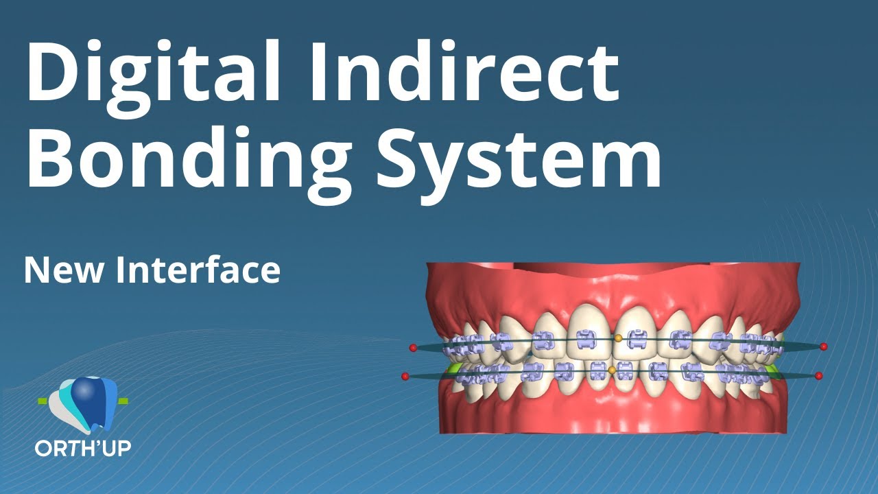 Digital Indirect Bonding System | ORTH'UP - YouTube