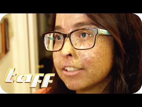 Leben wie ein Vampir! Die Mondscheinkrankheit | taff | ProSieben