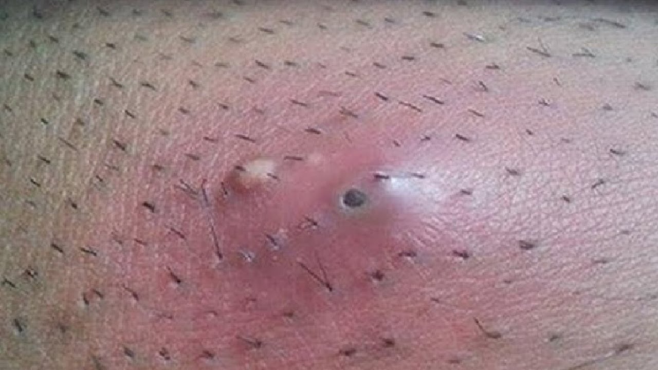 HOW TO GET RID OF RAZOR BUMPS AND INGROWN HAIRS EXTREMELY EASY - YouTube