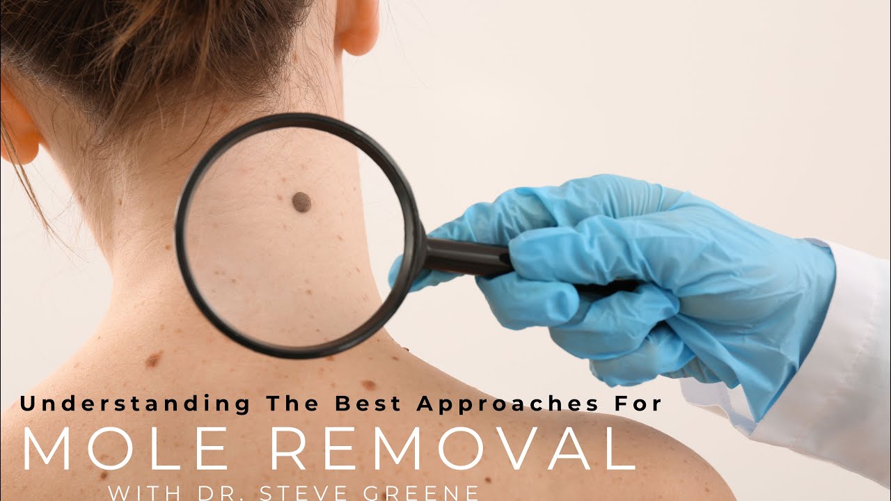 Understanding the best approaches for Mole Removals with Dr Steven ...