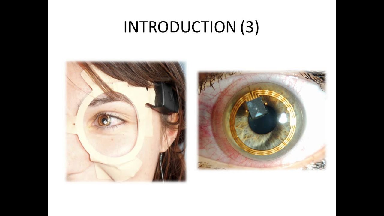 Sensimed Triggerfish, Hubanova R. et coll. - YouTube