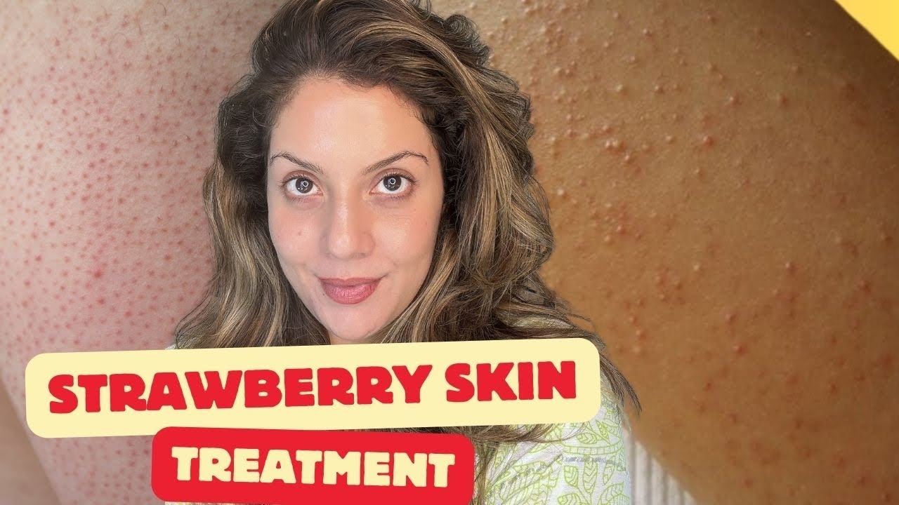 Strawberry Skin Treatment | Keratosis Pilaris Treatment at Home | Top ...