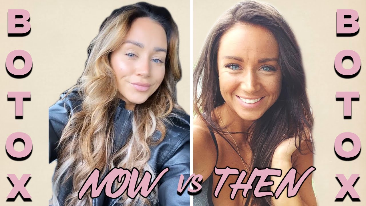 My Botox History and Why I do it - YouTube