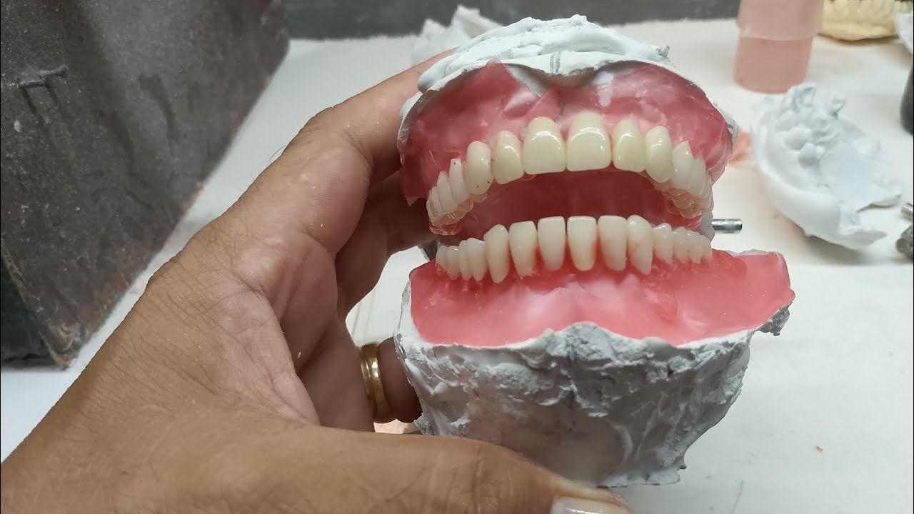 Lumang Full Denture (Rebase)Pinalitan ng Gums para maging Bago... - YouTube