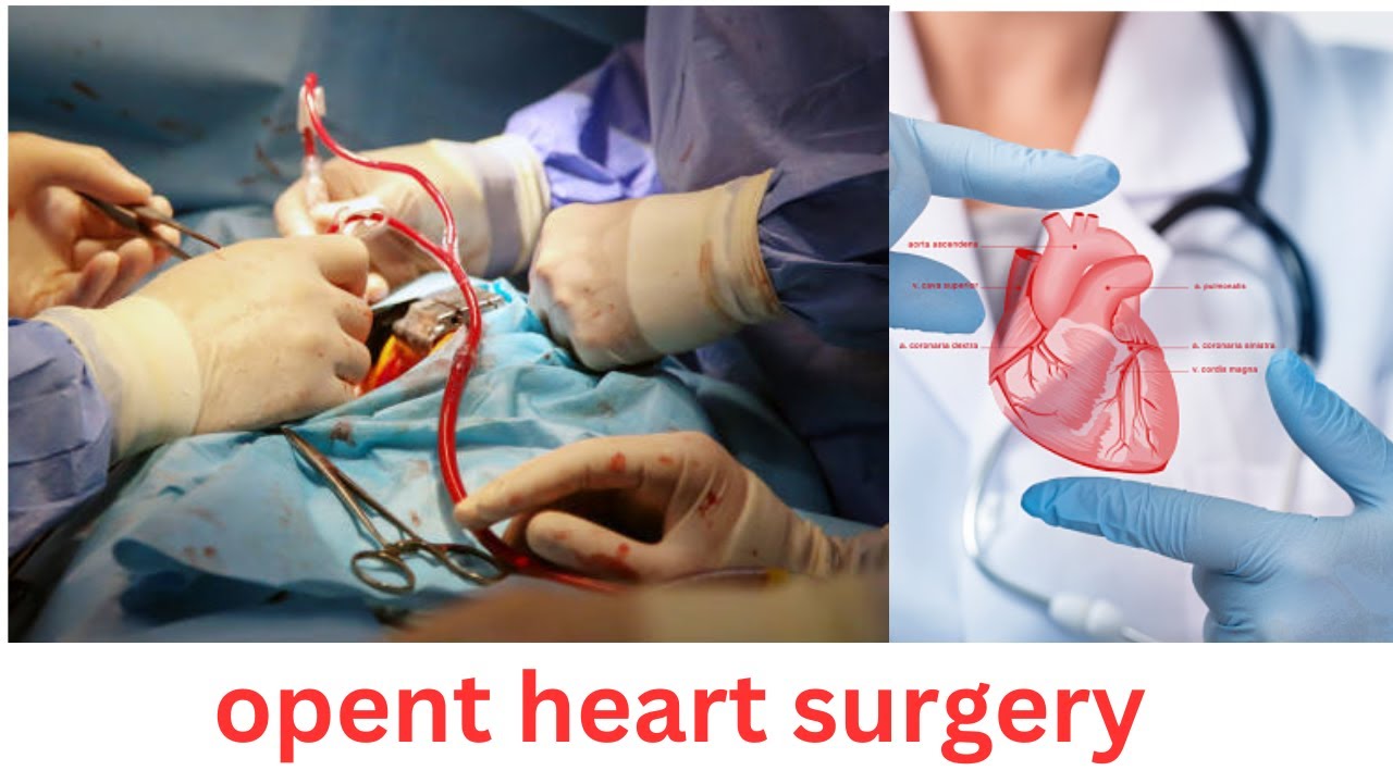 Awake cardiac surgery treatment ।।Real open heart surgery treatment usa ...
