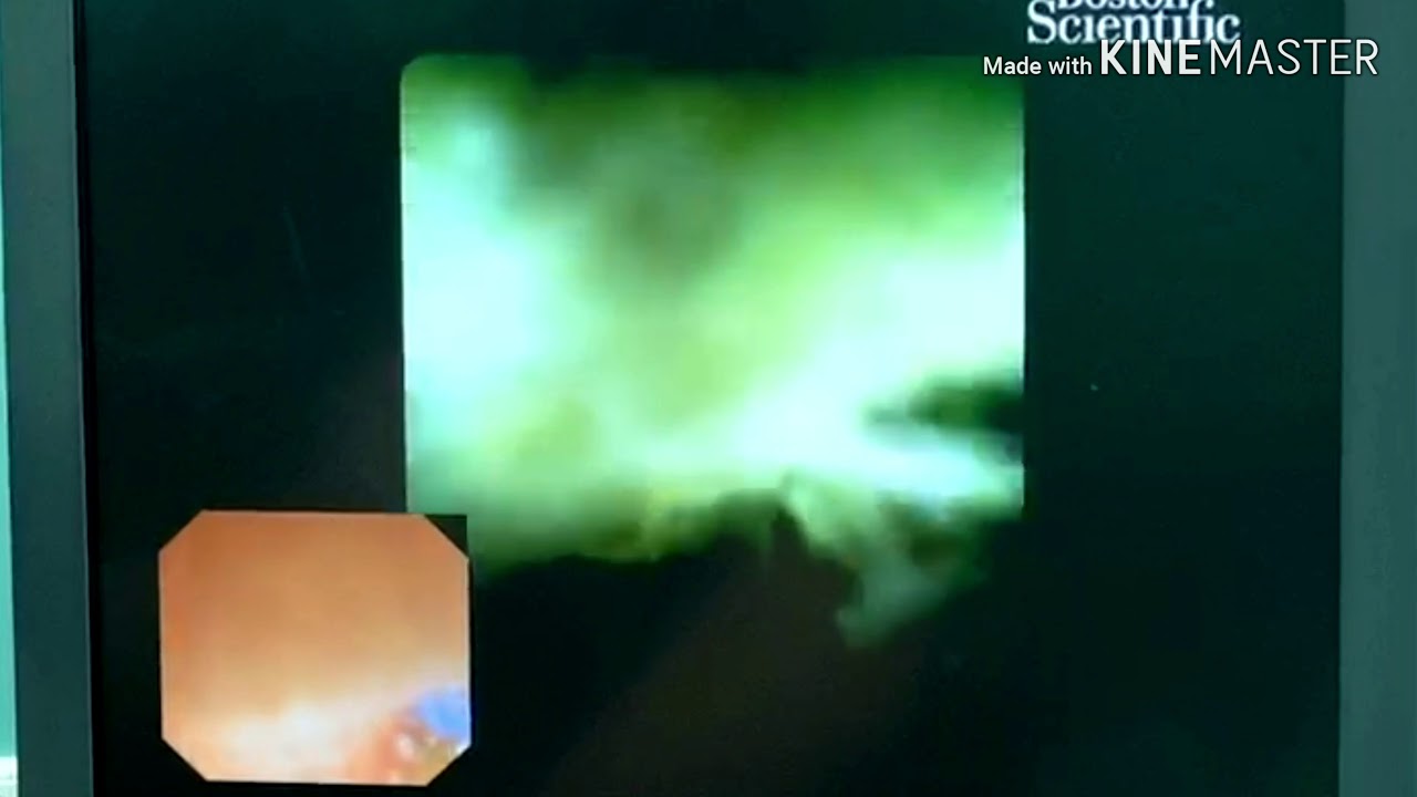 Electrohydraulic Lithotripsy (EHL) - TWFC - YouTube