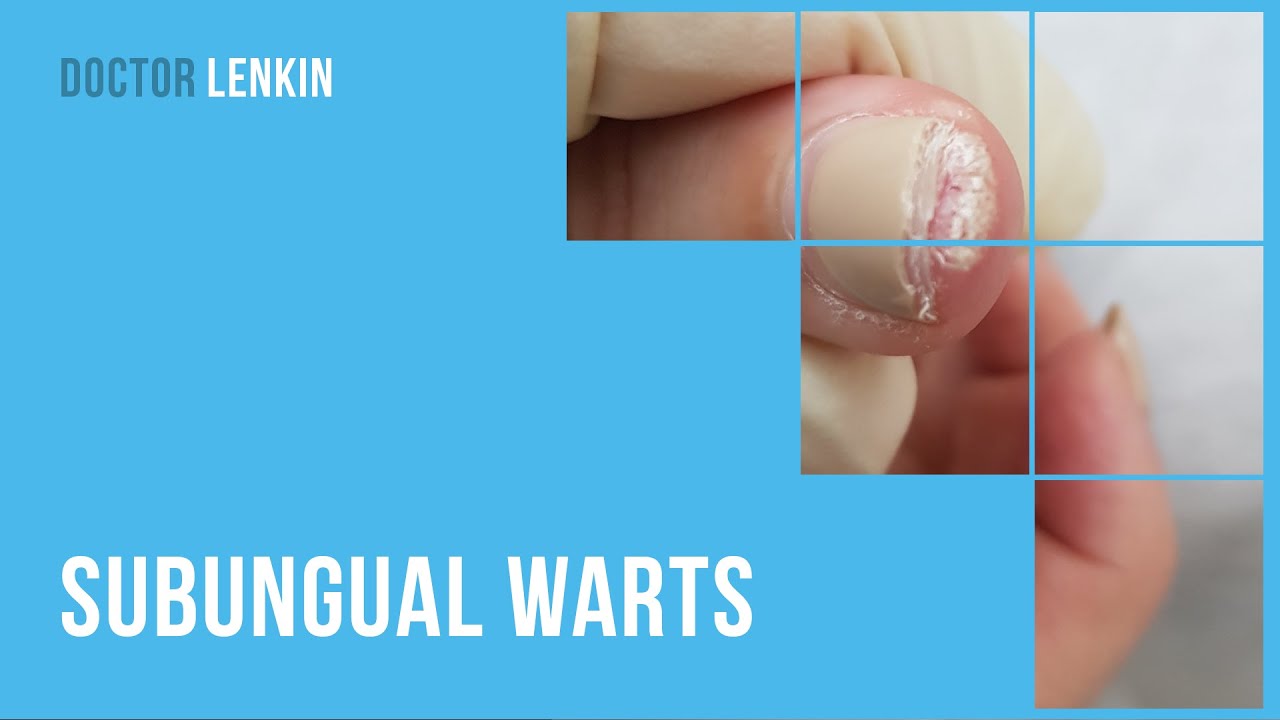 Subungual warts - YouTube