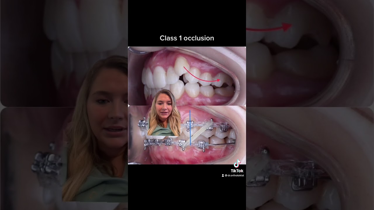 Class 1 occlusion #shorts #braces #orthodontist #teeth - YouTube