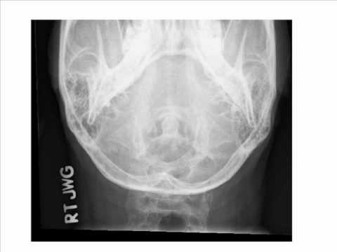 Fuchs Method -Dens.wmv - YouTube