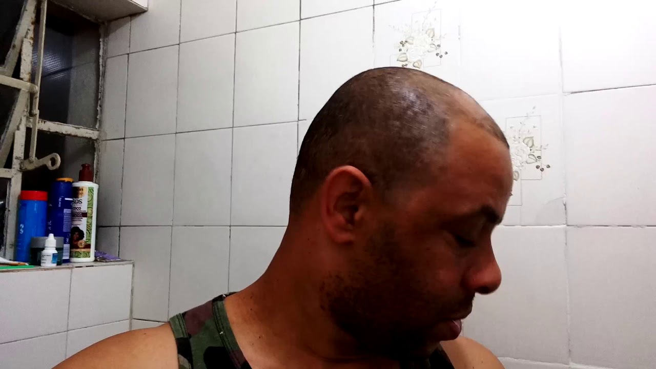 Como combater a foliculite na barba pagando pouco - YouTube