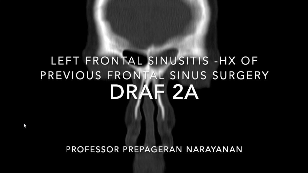 Revision Endoscopic Frontal Sinus Surgery (Draf II a) - YouTube