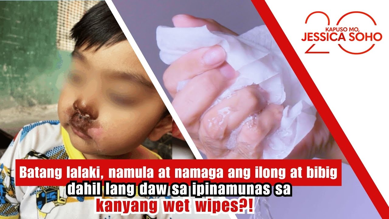 Batang lalaki, namula ang ilong at bibig dahil lang daw sa wet wipes ...